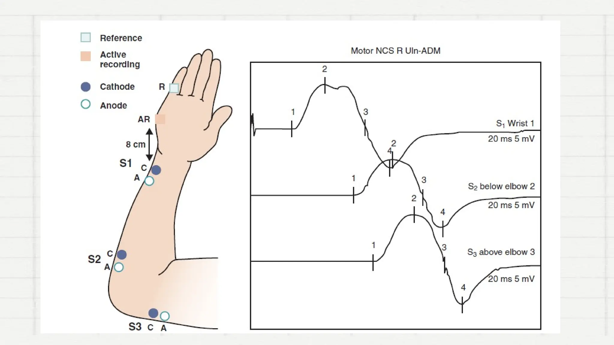 Nerve Conduction Study or NCS, Motor Conduction Study, Sensory Conduction Study, F Wave, H ...