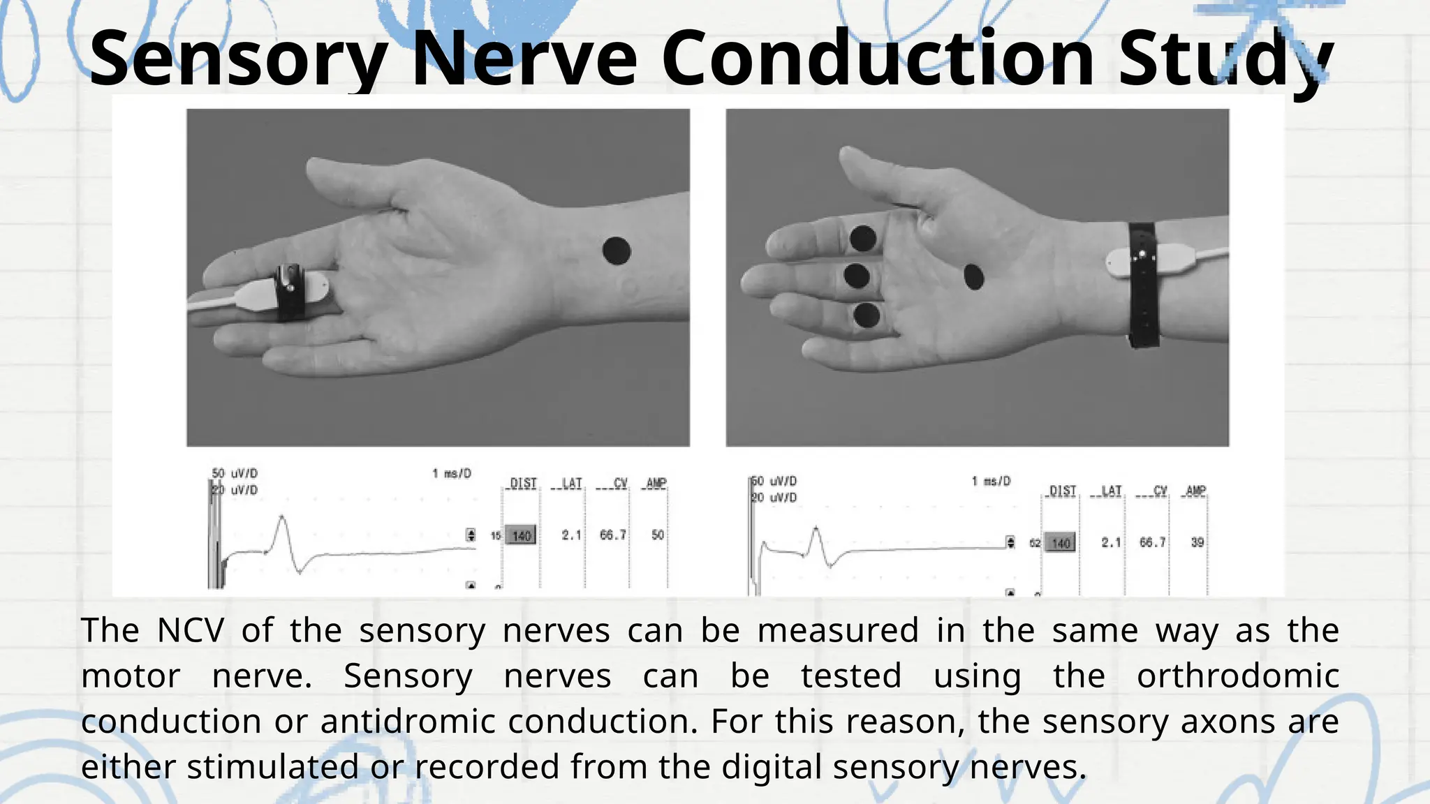 Nerve Conduction Study or NCS, Motor Conduction Study, Sensory Conduction Study, F Wave, H ...