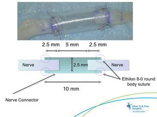 Nerve connector | PPT