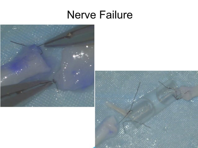 Nerve connector | PPT