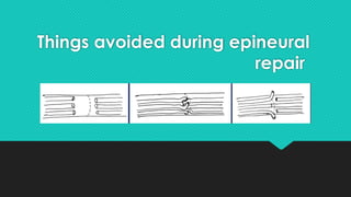 Nerve Grafting Principles , nerve repair by grafting | PPTX