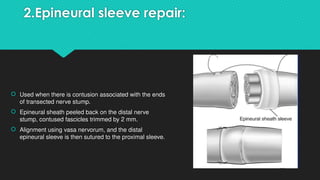Nerve Grafting Principles , nerve repair by grafting | PPTX