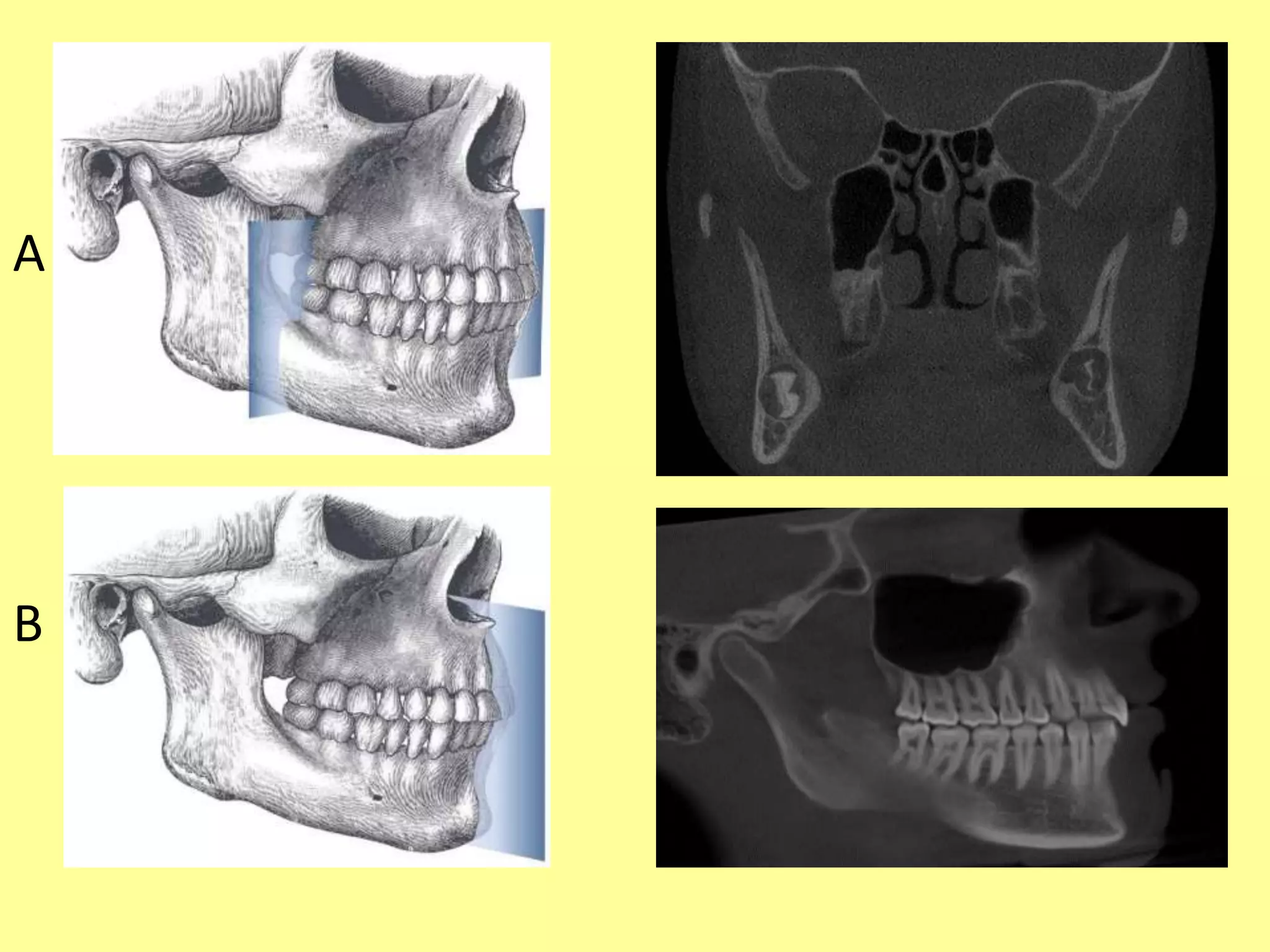 Nerve injuries during impaction surgeries | PPTX