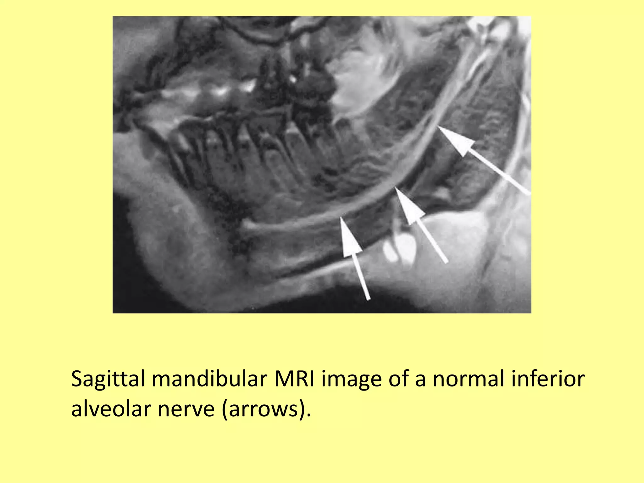 Nerve injuries during impaction surgeries | PPTX