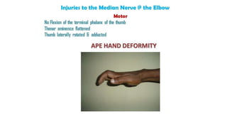 Ape Hand Deformity
