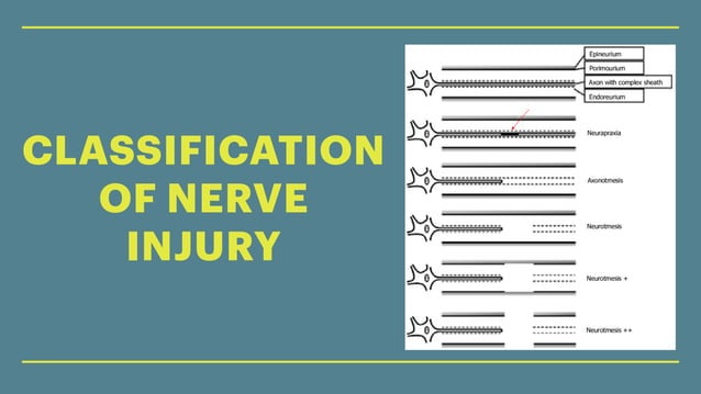 Nerve injuries | PPT
