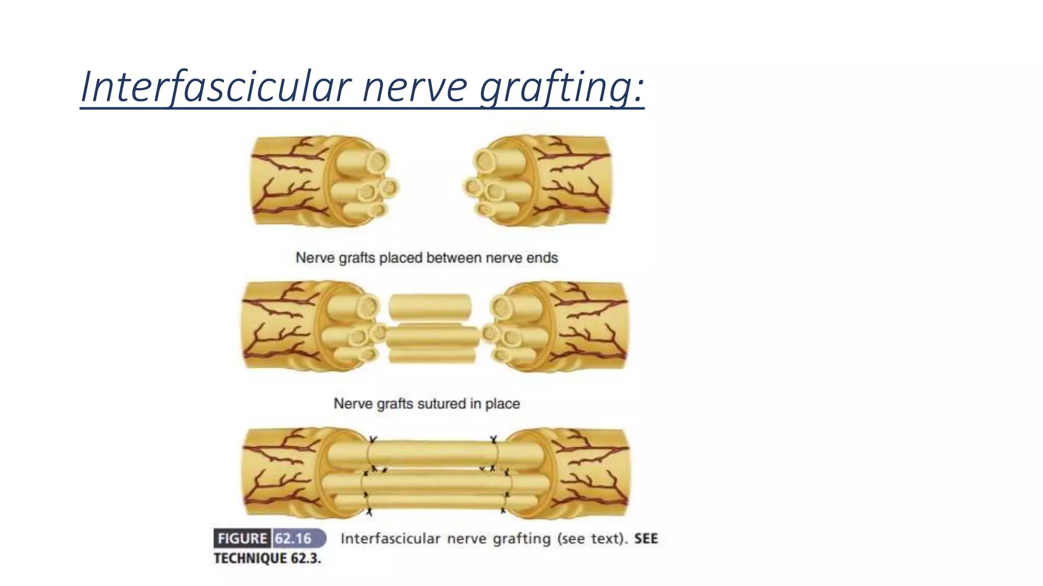 Nerve injuries | PPT