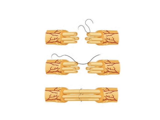 Nerve Injuries and its management techniues.pptx