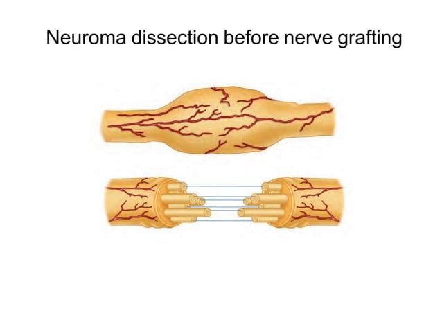 Nerve Injuries and its management techniues.pptx