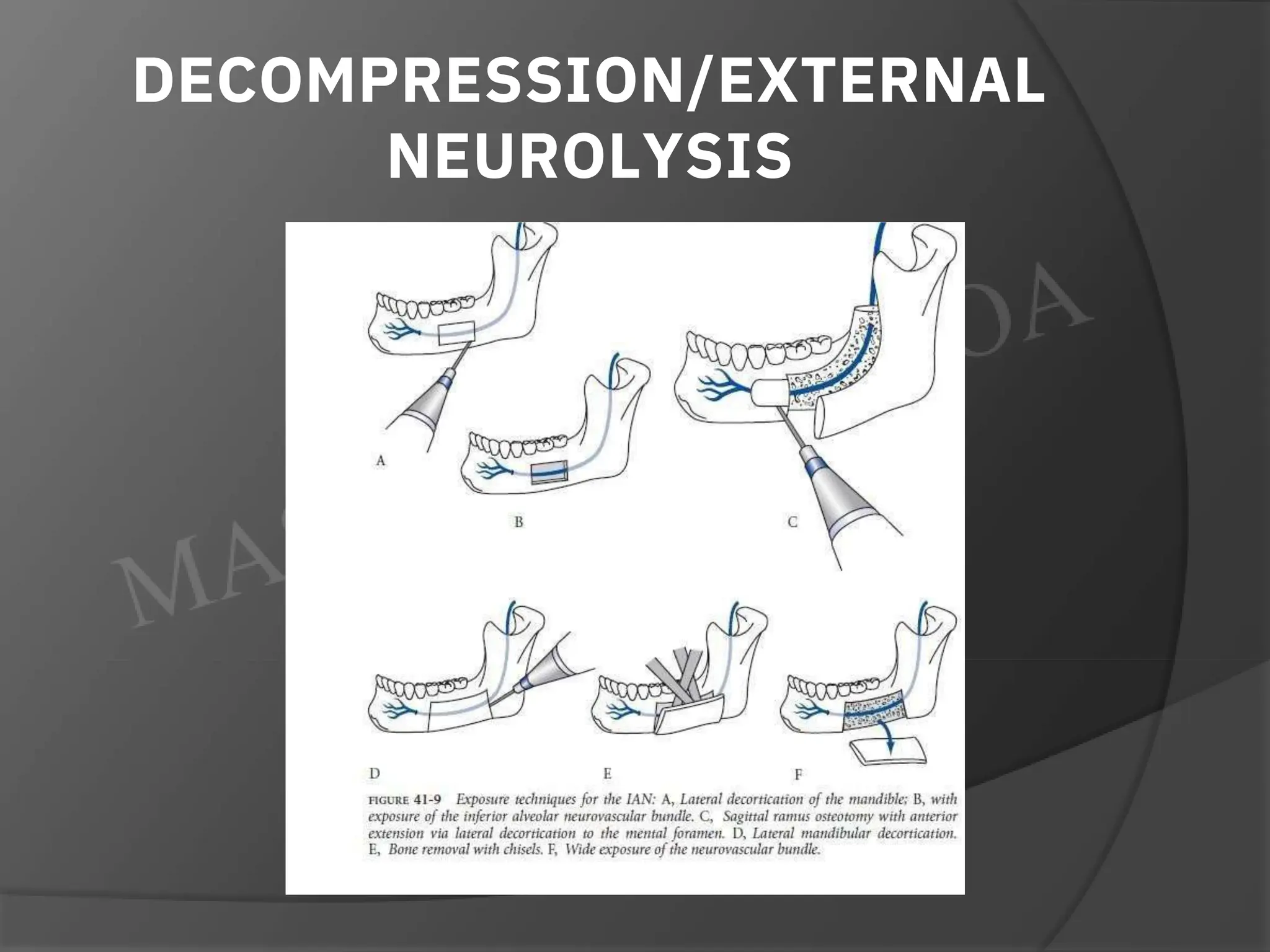 Nerve injuries seen in oral and maxillofacial surgery | PPTX