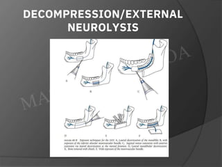 Nerve injuries seen in oral and maxillofacial surgery | PPTX