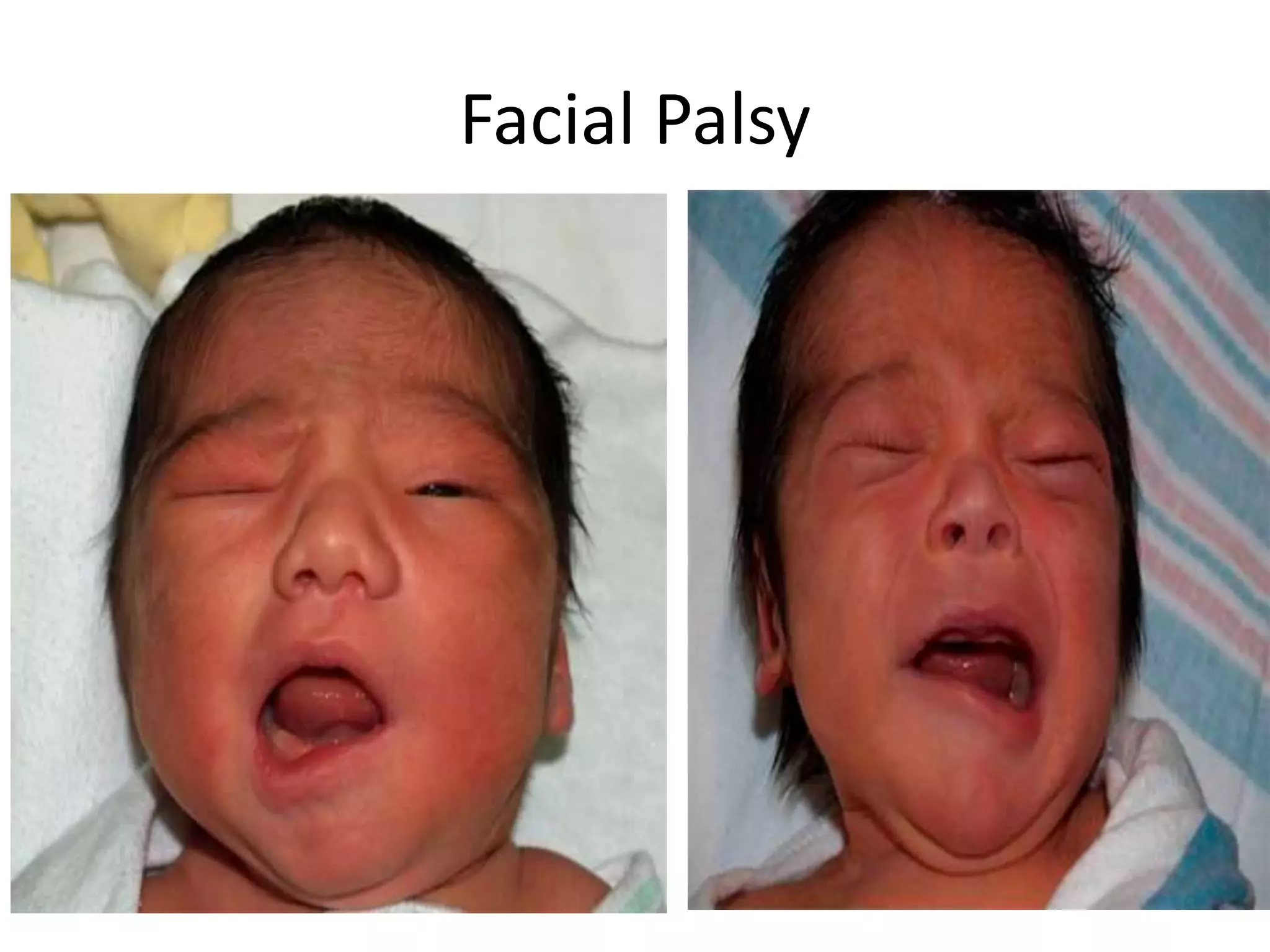 Nerve injuries ,fracture bone and dislocations in newborn part II | PPTX