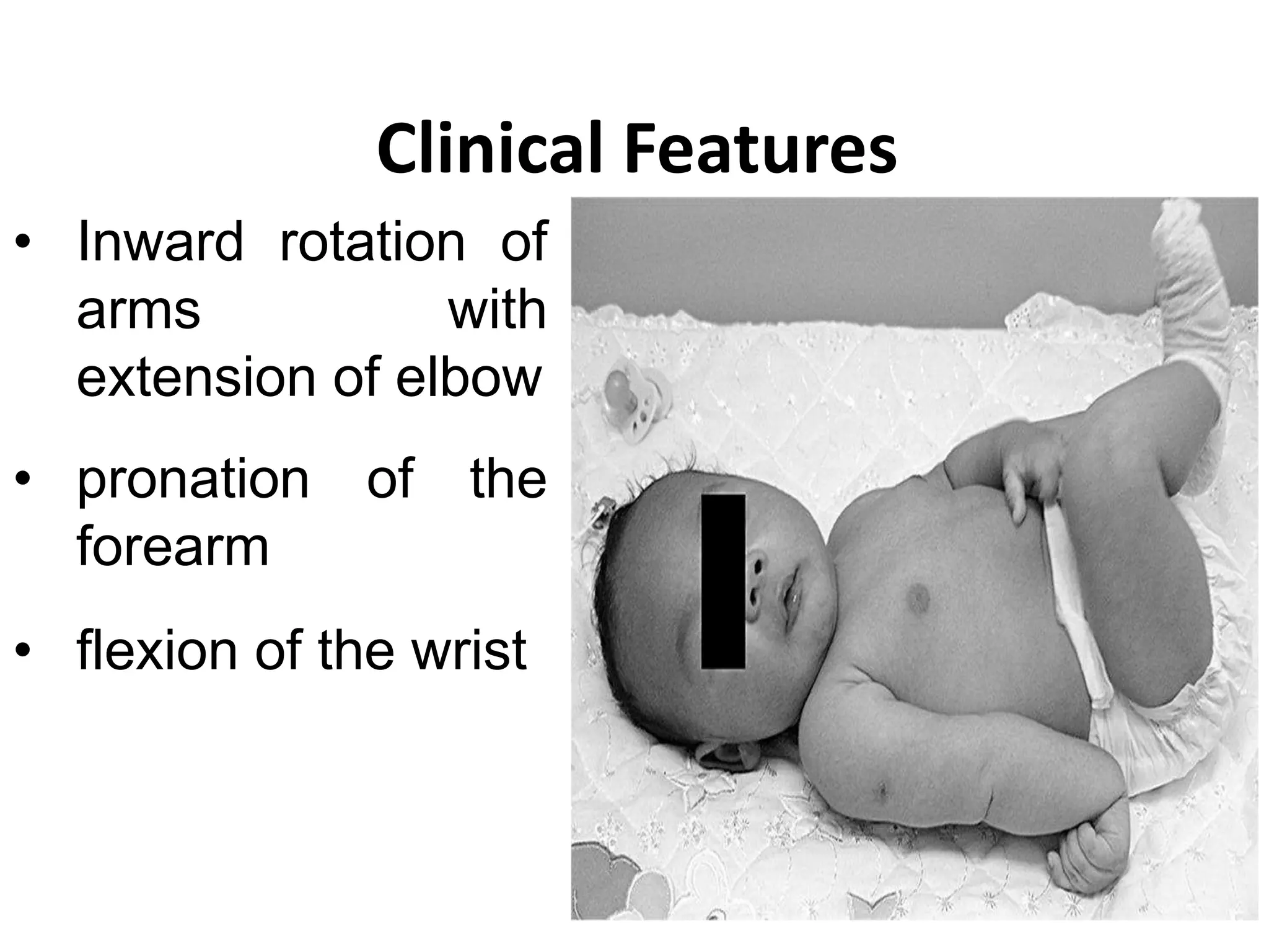 Nerve injuries ,fracture bone and dislocations in newborn part II | PPTX