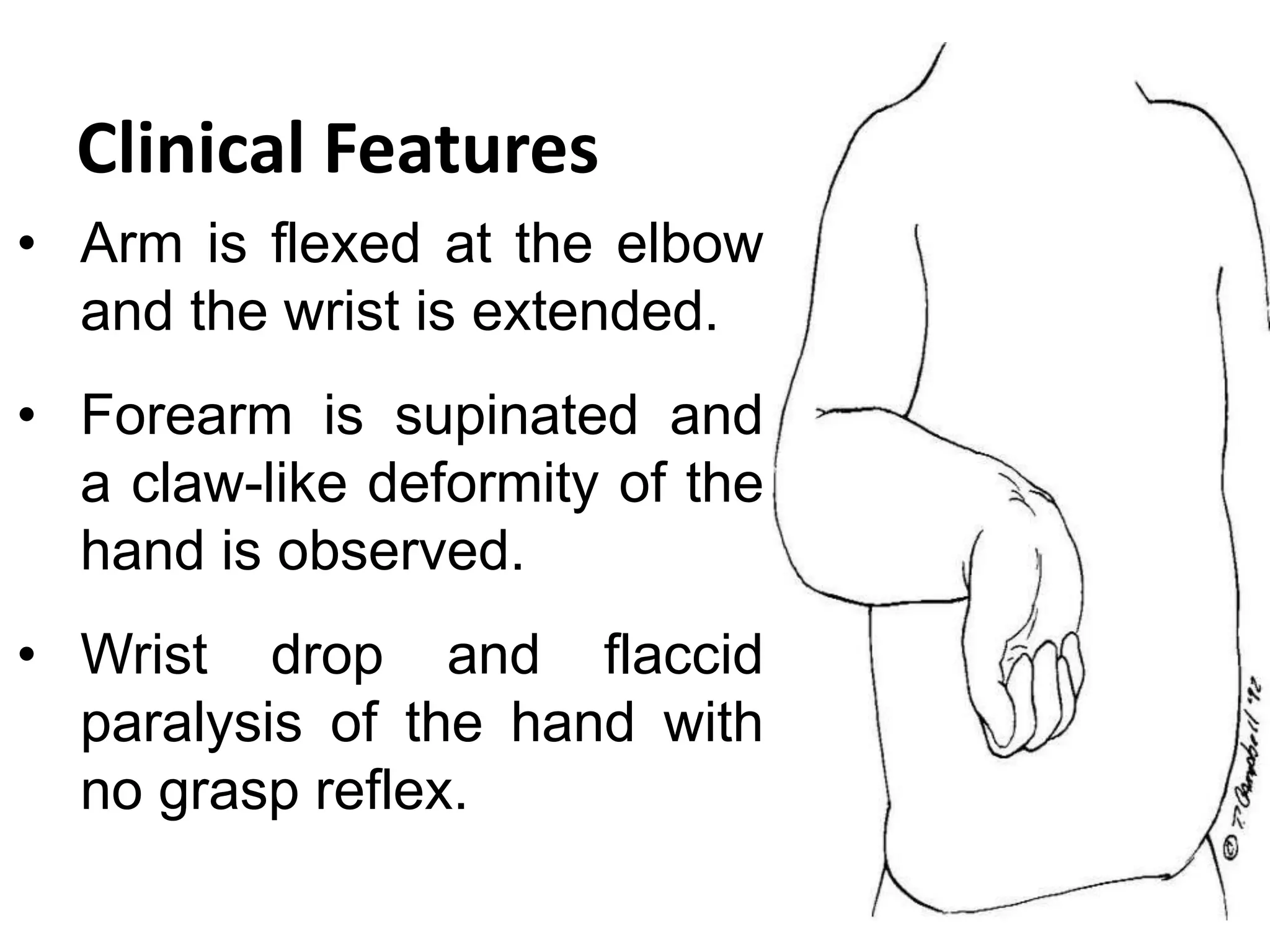 Nerve injuries ,fracture bone and dislocations in newborn part II | PPTX