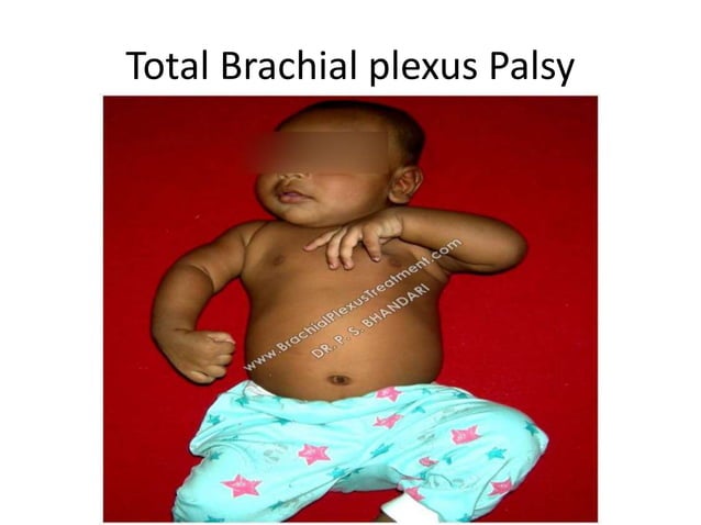 Nerve injuries ,fracture bone and dislocations in newborn part II | PPTX