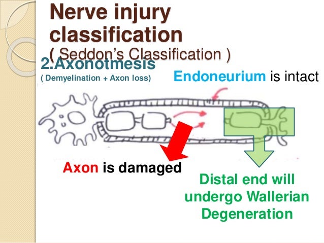 Nerve injury