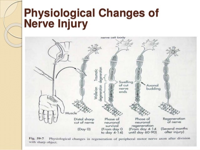 Nerve injury