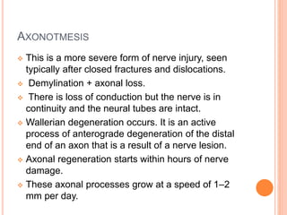 nerve injury kjNOCNIUABCIUBIWEUBIUBUKWBIUBIW | PPT