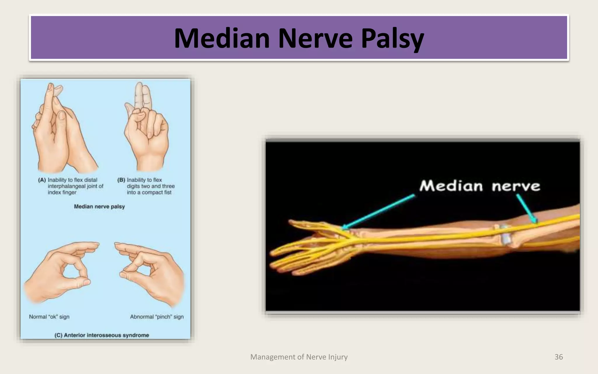 Management of Nerve Injury | PPTX