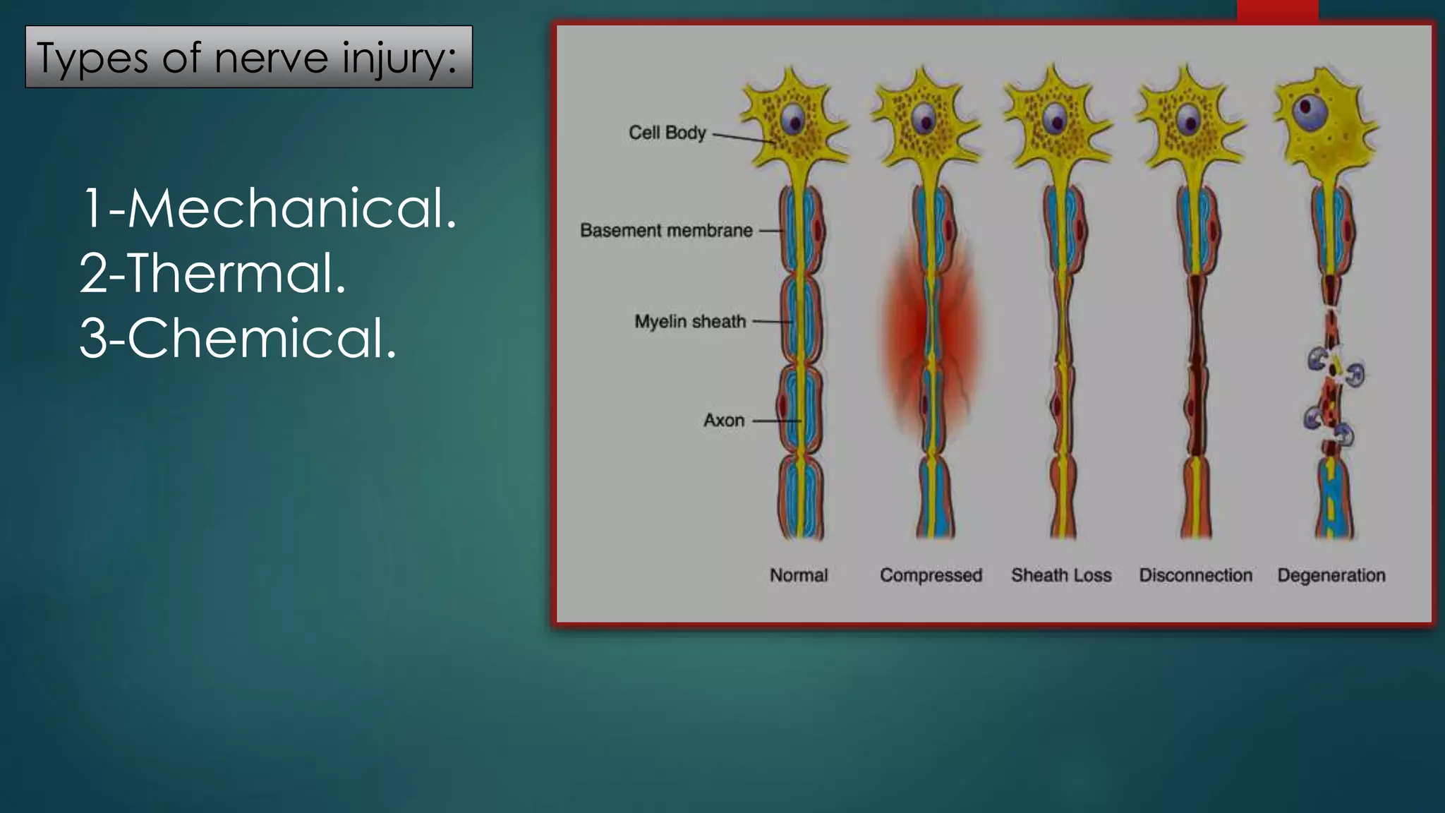 Nerve injury and repair | PPT