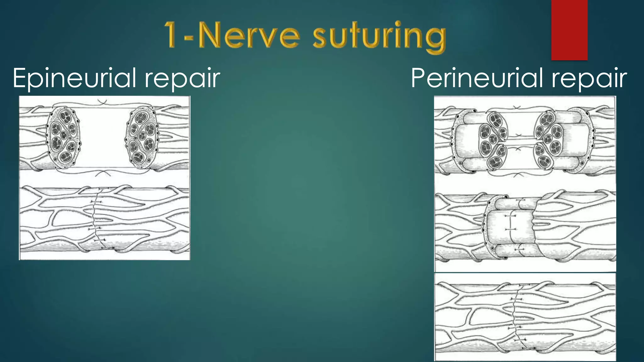 Nerve injury and repair | PPT