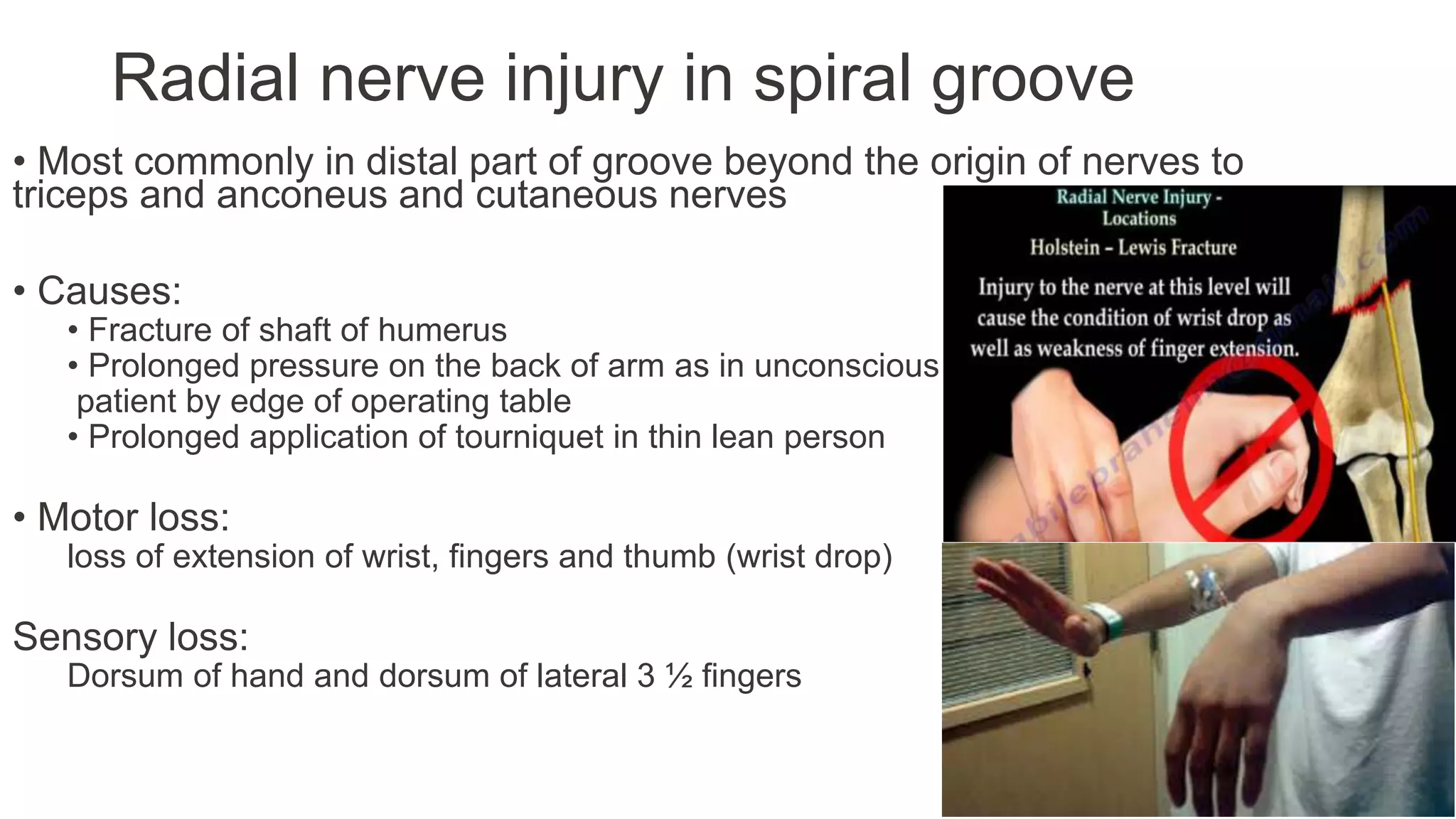 Nerve injury of upper limb | PPTX