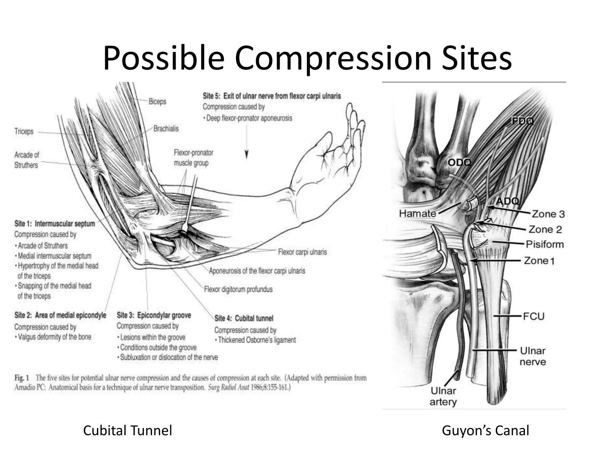 Ulnar Nerve Injury.pptx