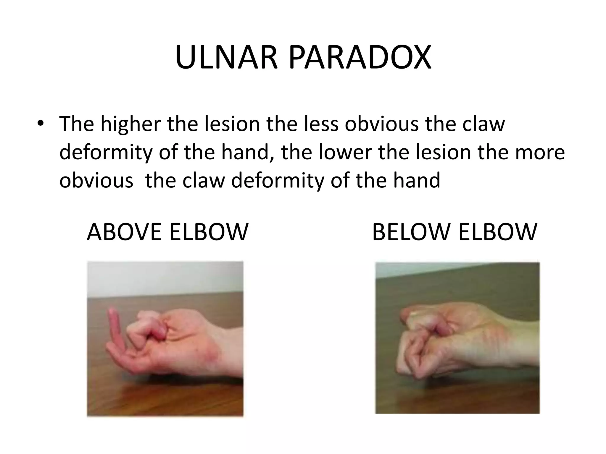 Ulnar Nerve Injury.pptx