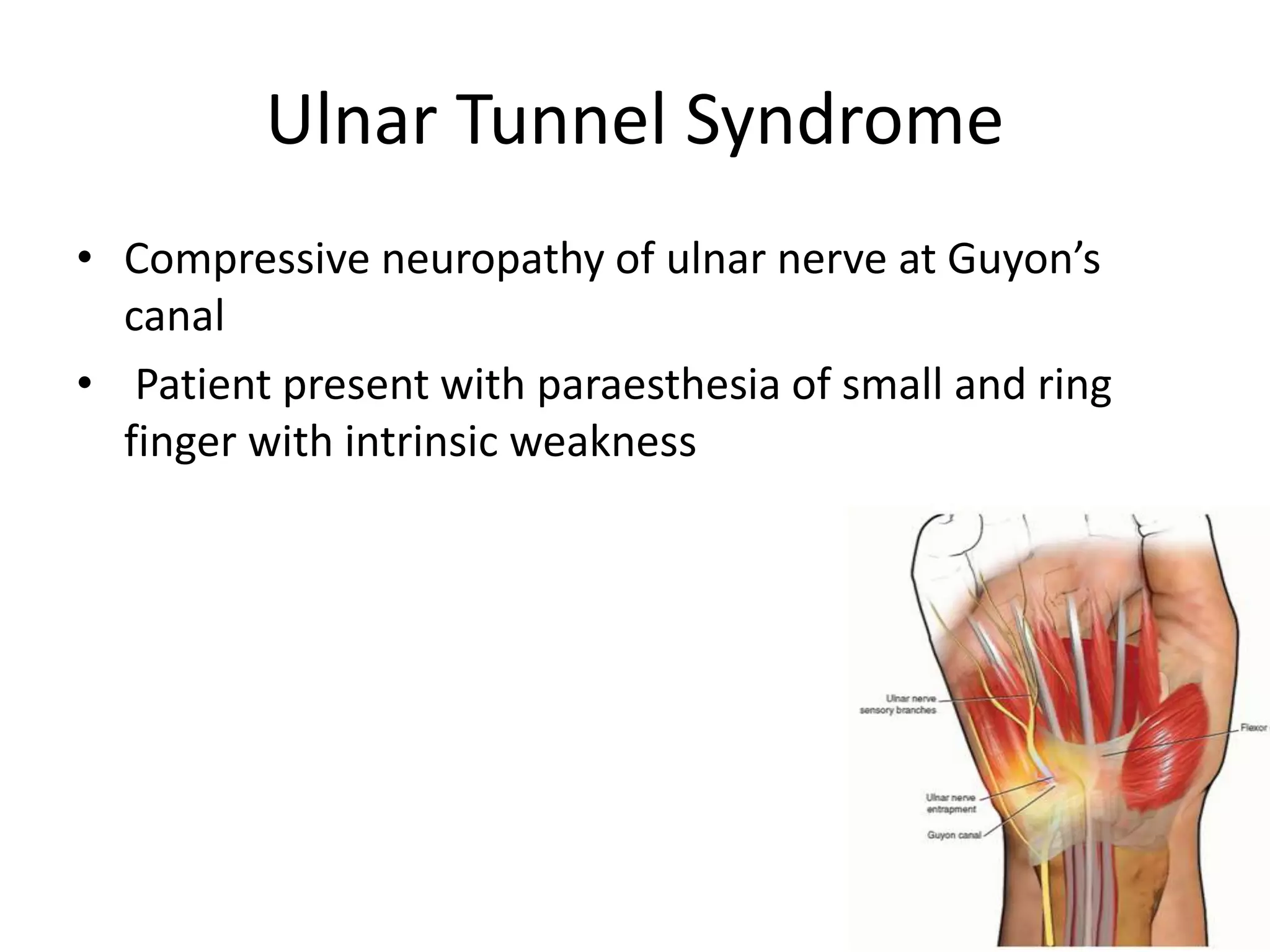Ulnar Nerve Injury.pptx