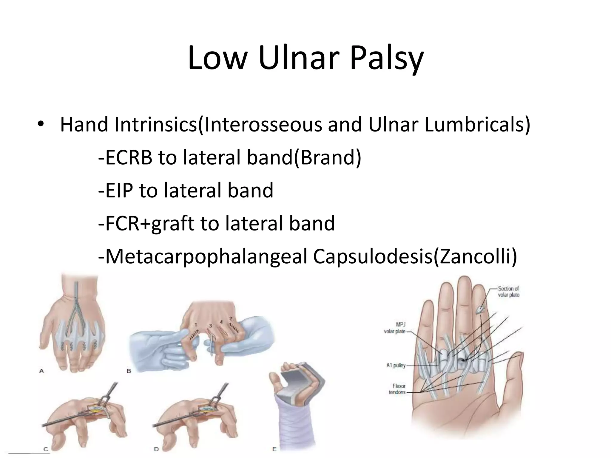 Ulnar Nerve Injury.pptx
