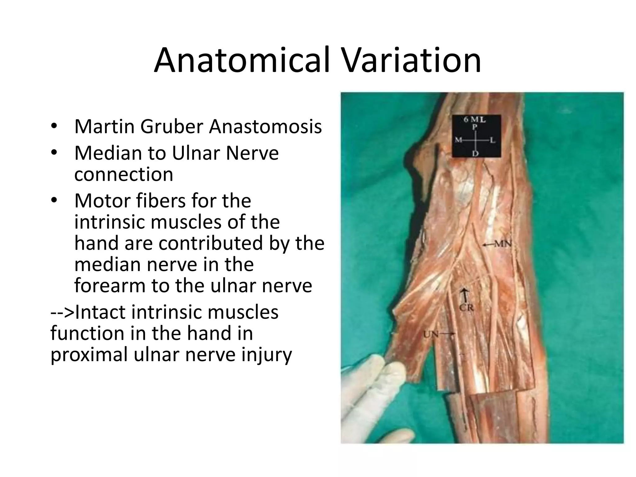 Ulnar Nerve Injury.pptx