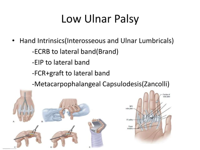 Ulnar Nerve Injury.pptx | Death, Injury, or Military Conflict ...