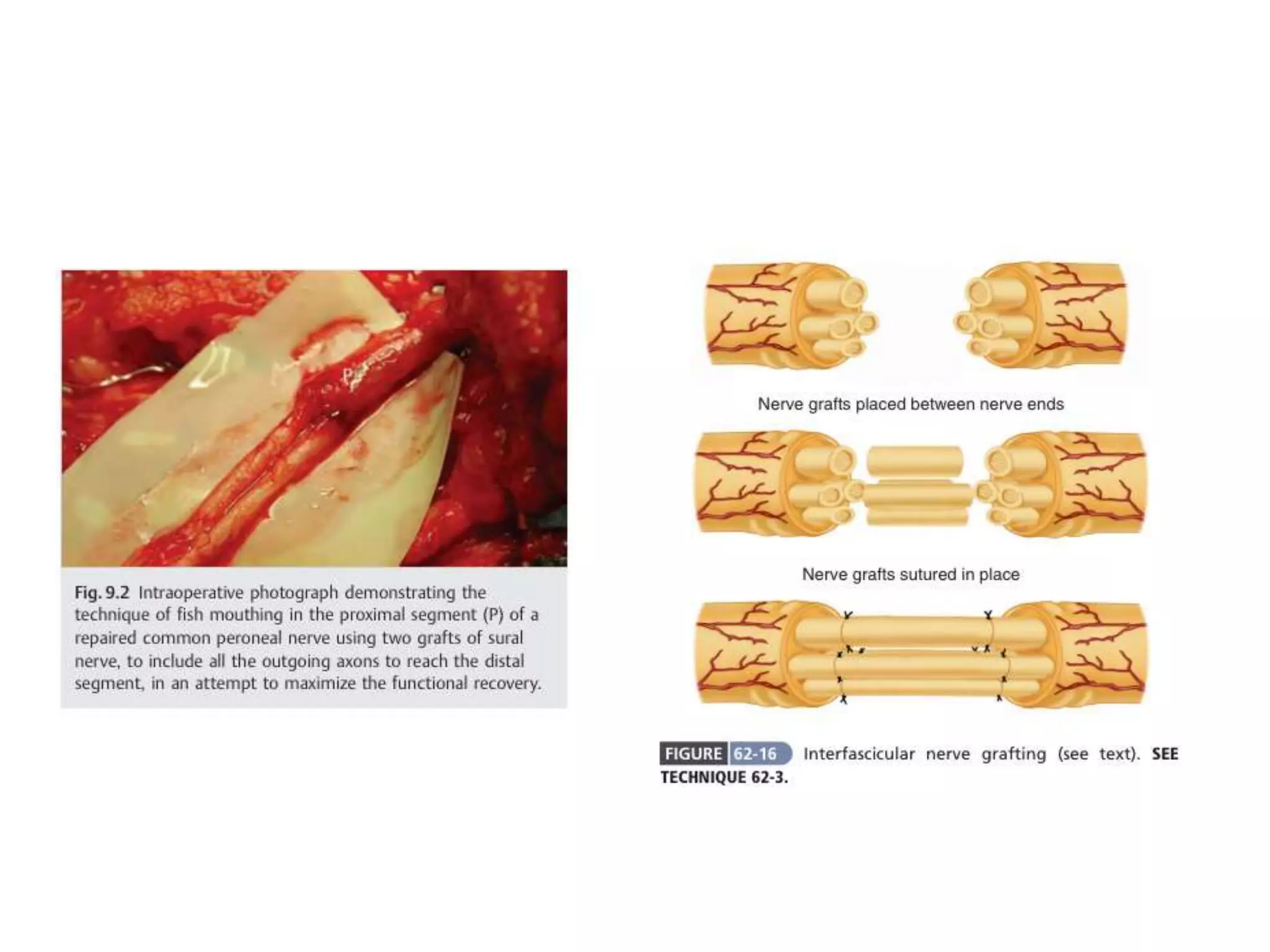 Nerve repair.pptx