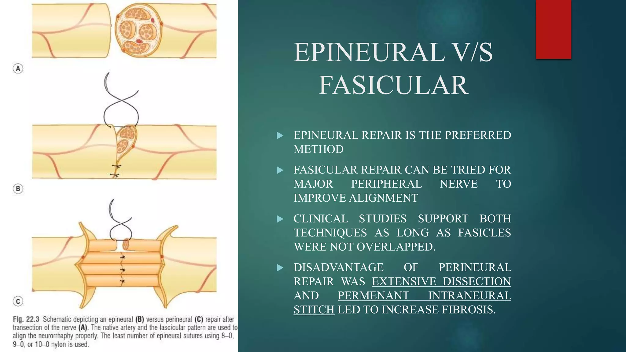 Nerve repair and grafting | PPTX