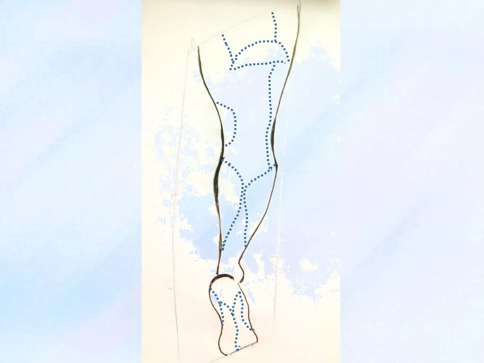 Plexuses, Cutaneous innervation, Dermatome, Axial line of the lower ...