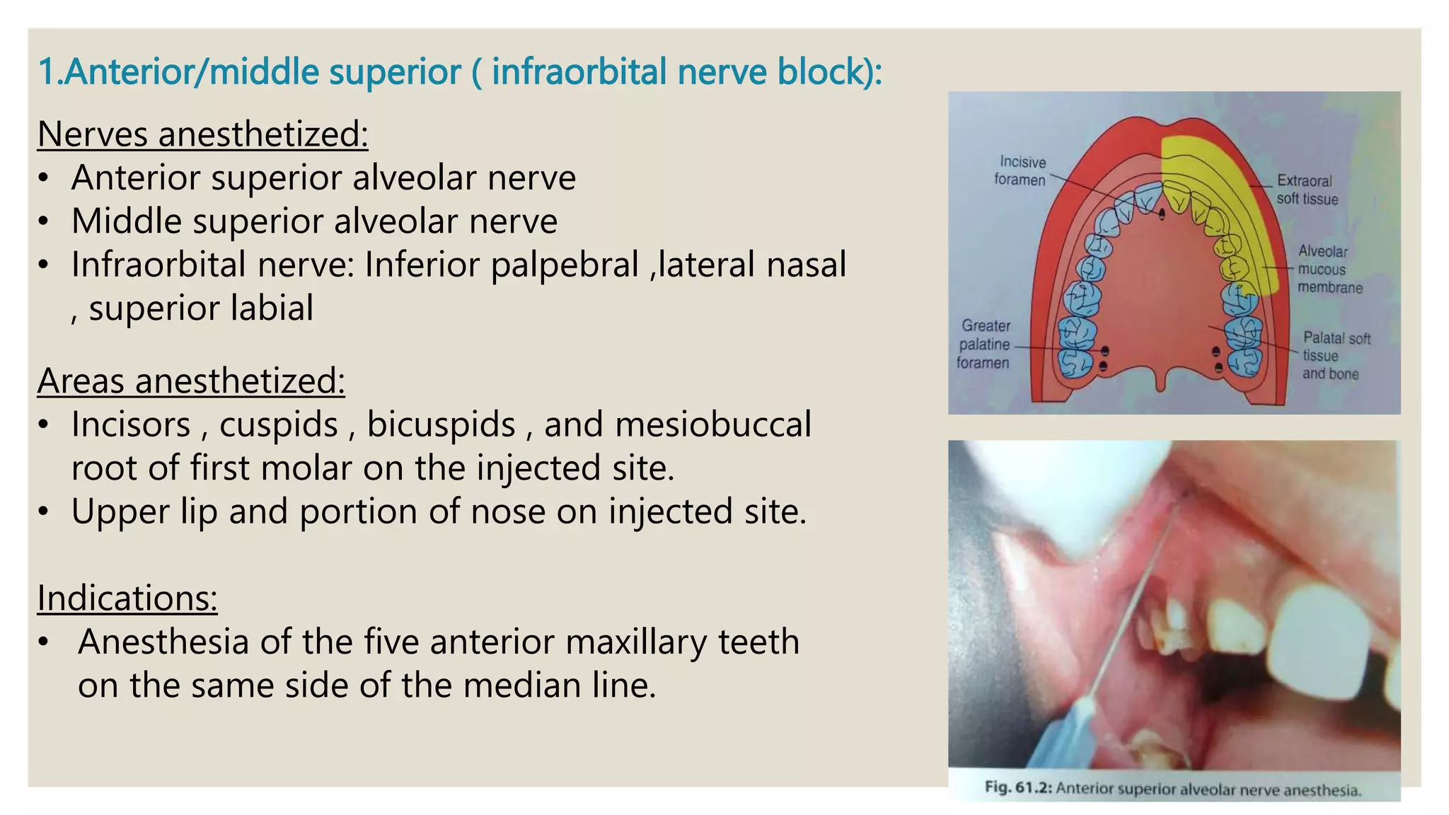 Nerve supply and anesthesia in maxillary arch.pptx