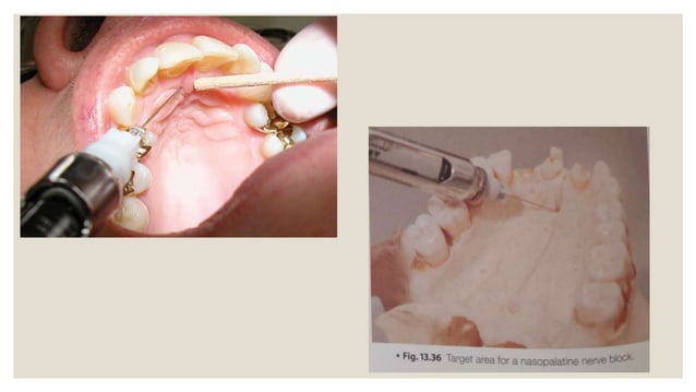 Nerve supply and anesthesia in maxillary arch.pptx
