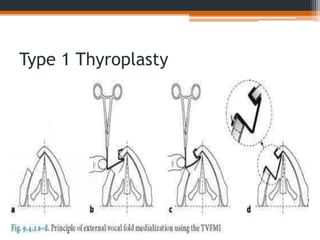 Nerve supply of larynx & laryngeal paralysis | PPTX