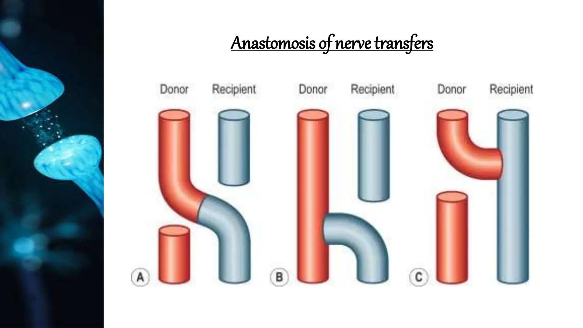 NERVE TRANSFER (Basic idea and types of nerve transfer) | PPTX