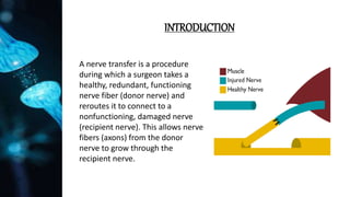 NERVE TRANSFER (Basic idea and types of nerve transfer) | PPTX