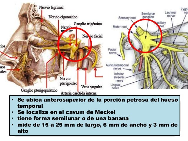 Cavum Trigéminal De Meckel: Neuroimaging Of Meckel’S Cave – DUZNS