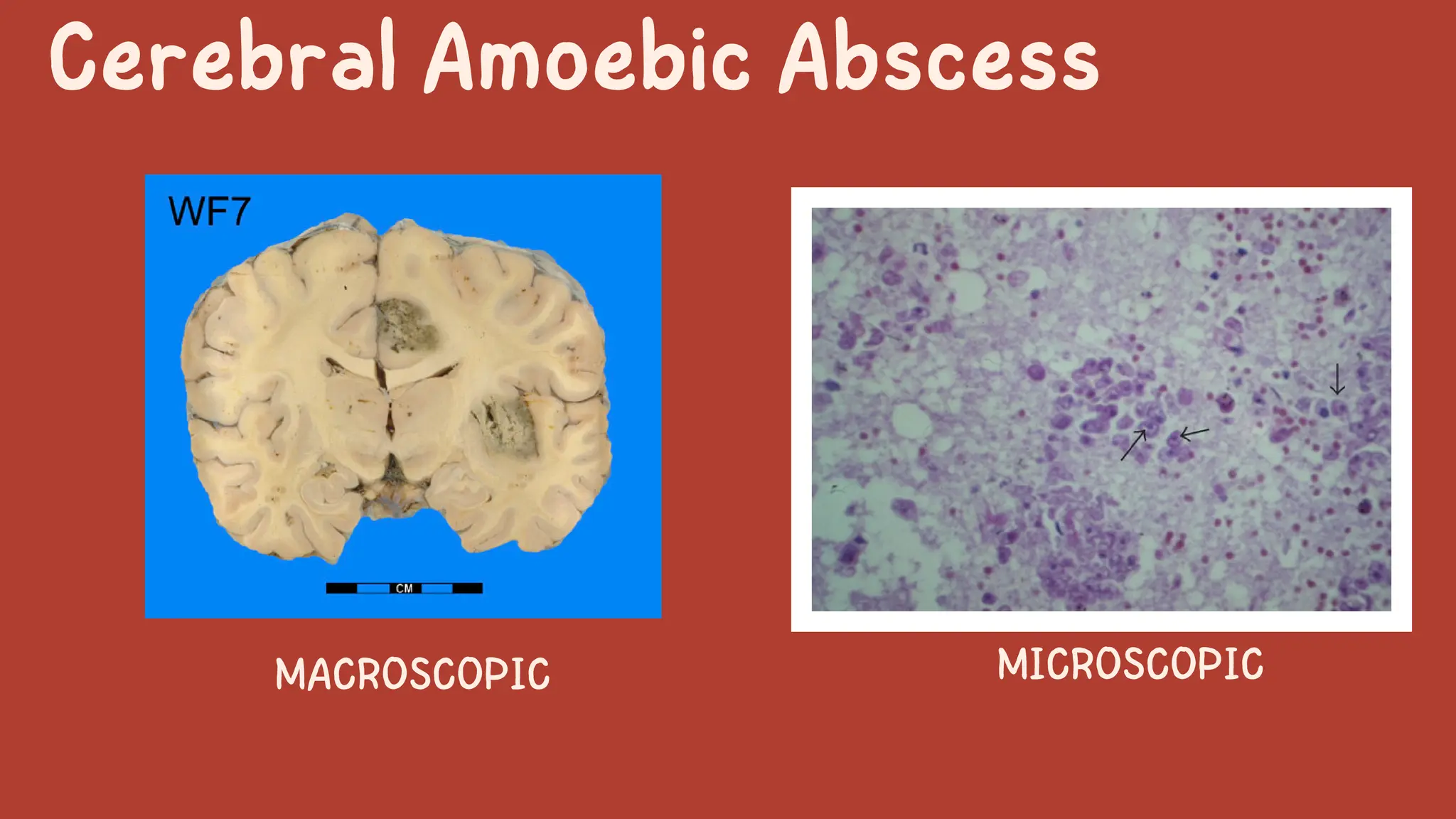 The Bacterial and Viral Infections of the Nervous System | PDF