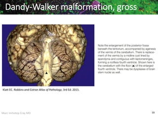 Dandy Walker Malformation Gross