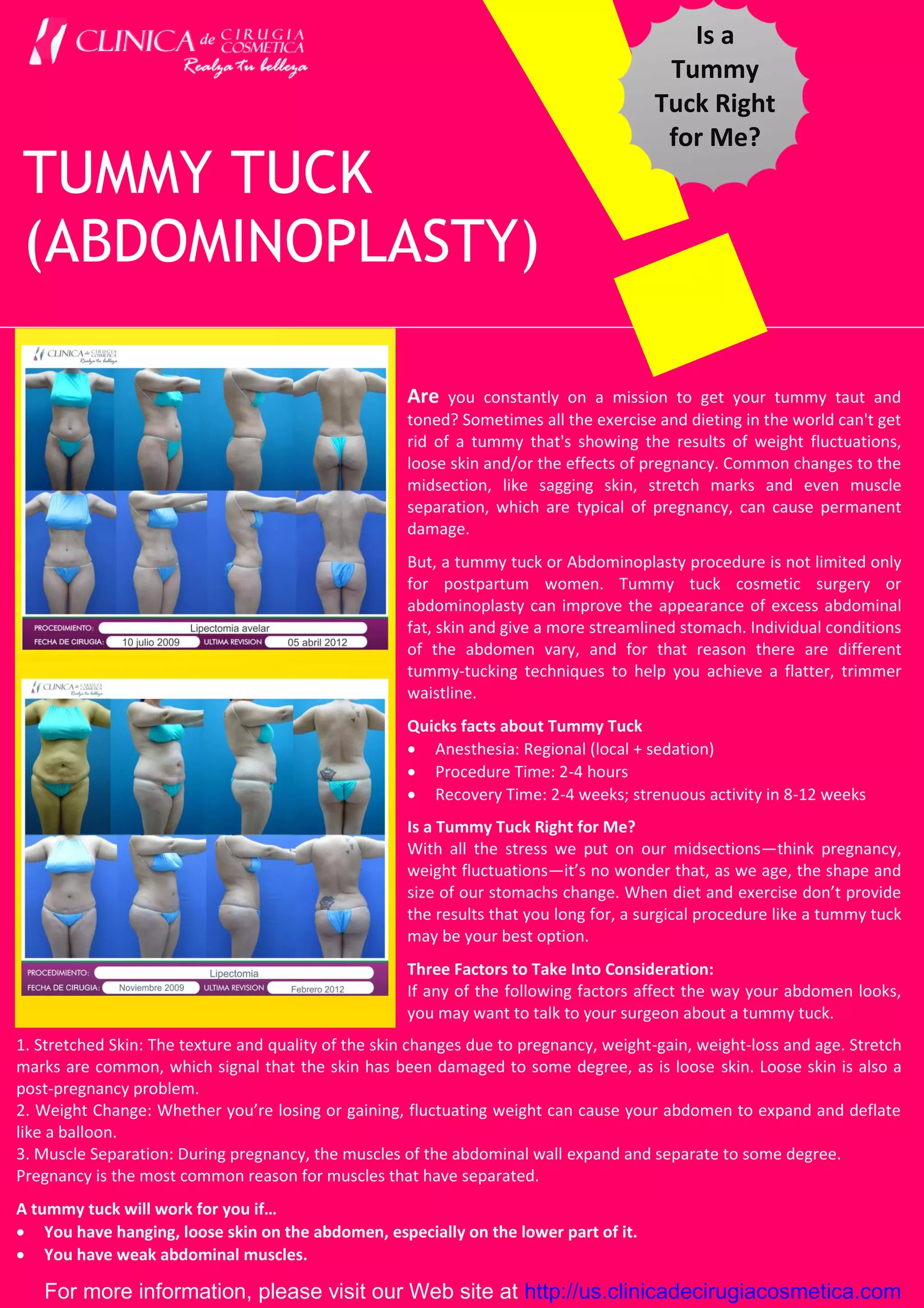 TUMMY TUCK (ABDOMINOPLASTY) | PDF
