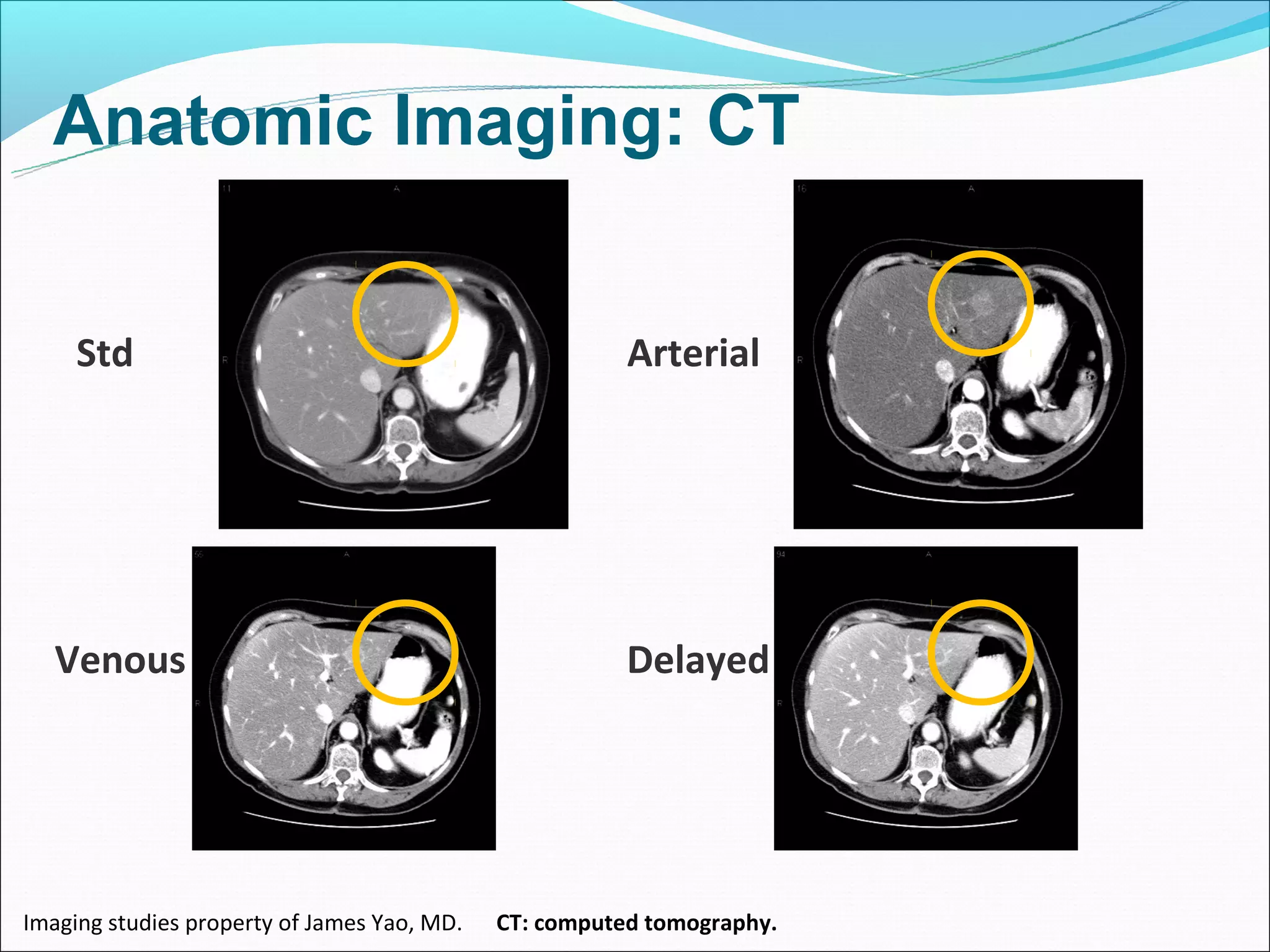 GASTROENTEROPANCREATIC NEUROENDOCRINE TUMORS | PPT