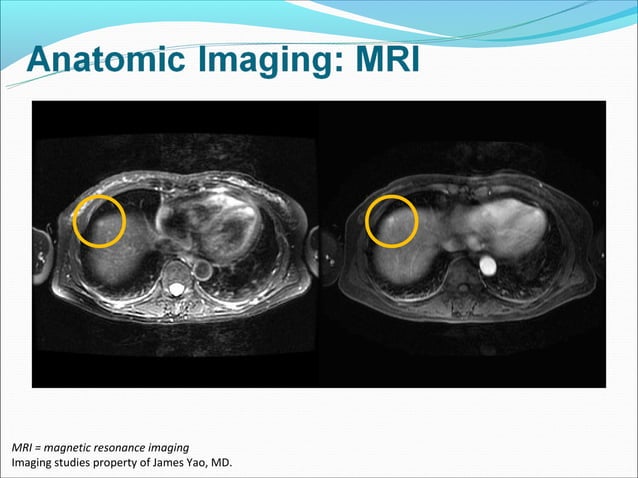 GASTROENTEROPANCREATIC NEUROENDOCRINE TUMORS | PPT