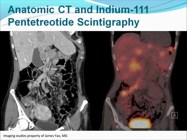 GASTROENTEROPANCREATIC NEUROENDOCRINE TUMORS | PPT