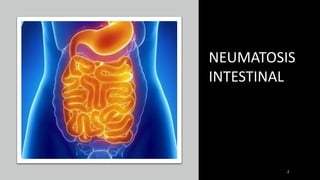 Abdomen agudo: Neumatosis intestinal / neumoperitoneo / FAST | PPTX