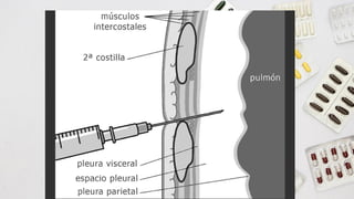 neumo%20a%20tension.pdf