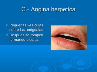 Neumocardiología anginas e infecciones virosicas de vías aéreas | PPT